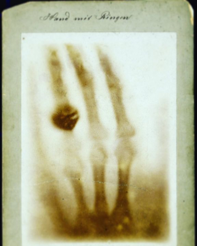 Στις 22 Δεκεμβρίου 1895 ο Wilhelm Röntgen 🥼ακτινοβόλησε το χέρι της ...